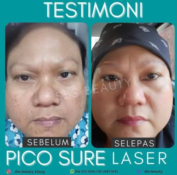 Pico Sure Laser - SBS Aura Beauty